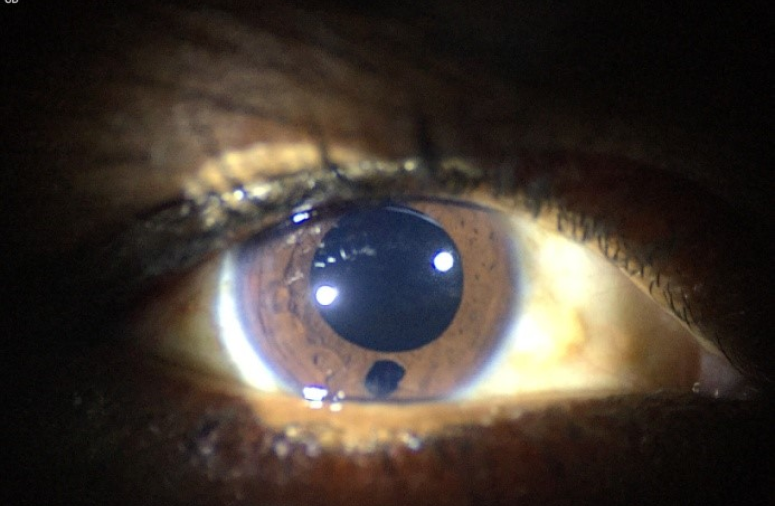 Remidio PSL D20 | Hand Held Portable Slit Lamp